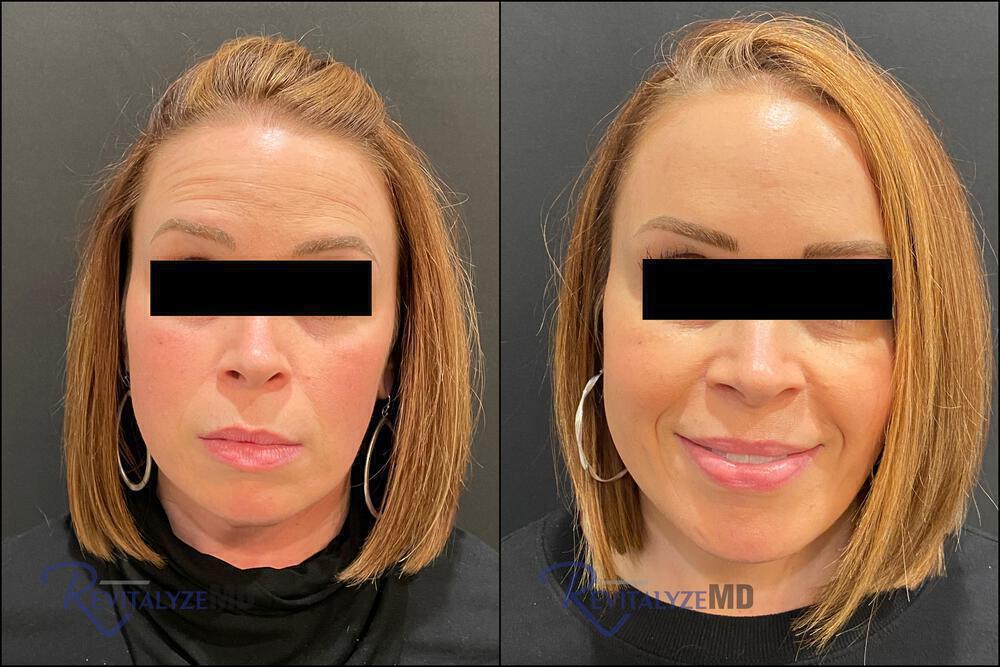 Botox Knoxville, TN | Cosmetic Dermal Surgeon