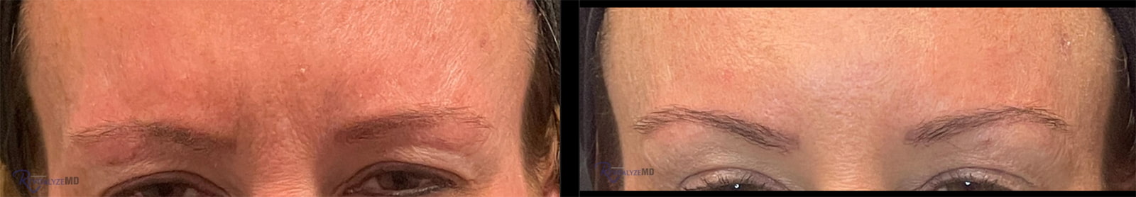 Botox Knoxville, TN | Cosmetic Dermal Surgeon