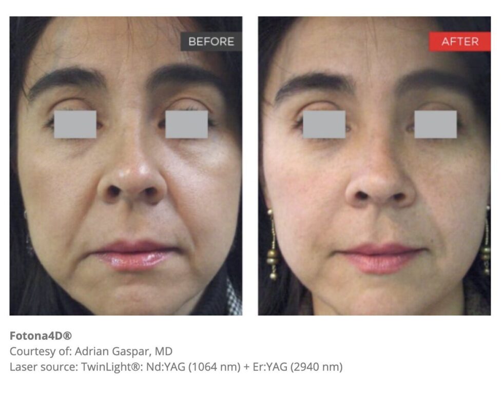 The Top 5 Non-surgical Facelift Treatments | Revitalyze MD