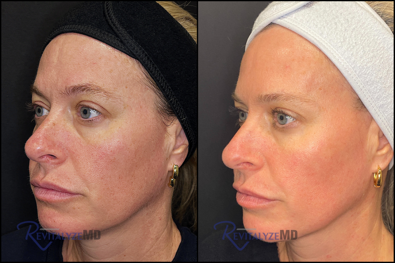 Hollywood Spectra Laser Peel — RevitalyzeMD Knoxville